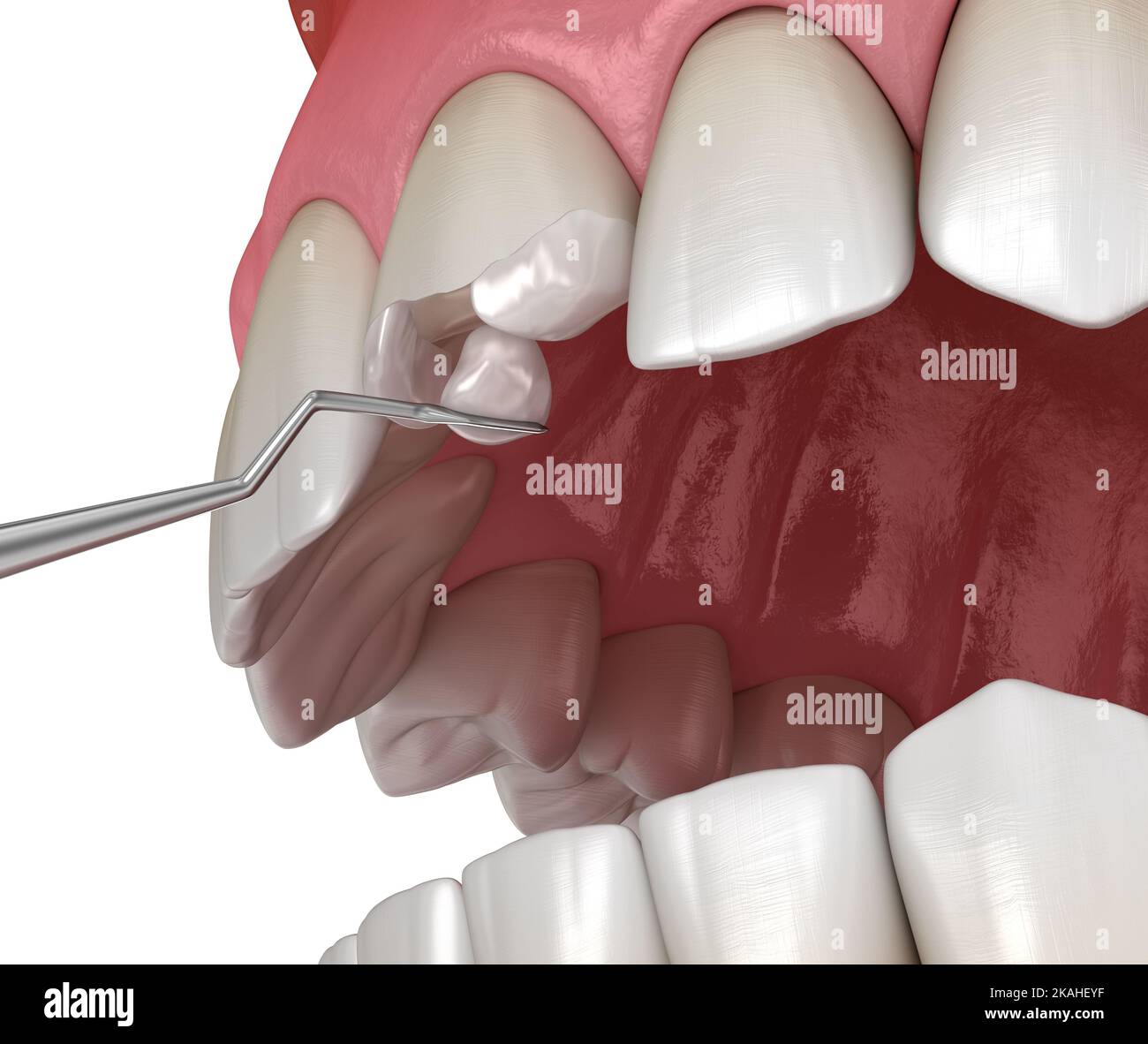 Restoration of broken tooth. Medically accurate 3D illustration Stock ...