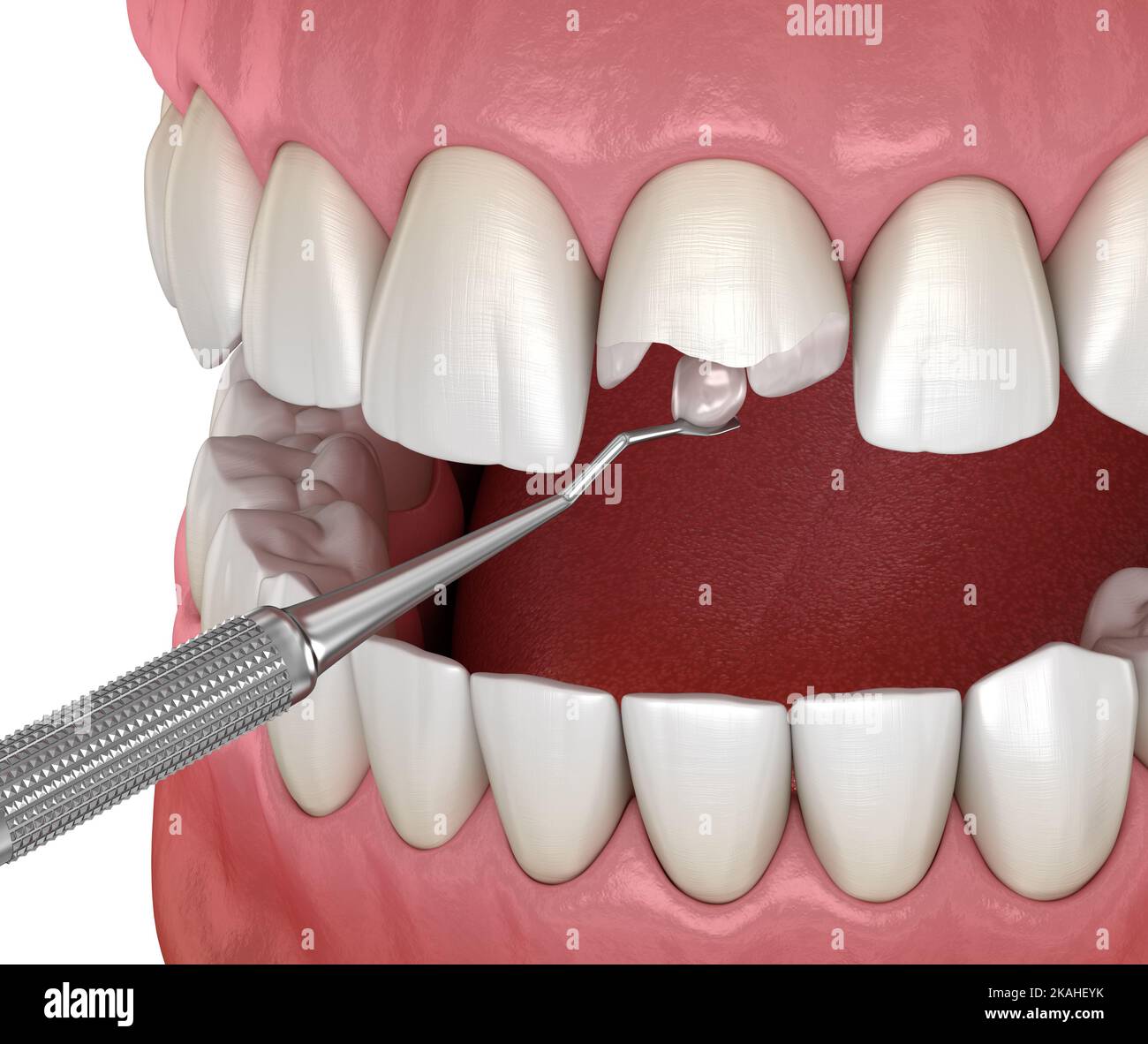 Restoration of broken tooth. Medically accurate 3D illustration Stock ...