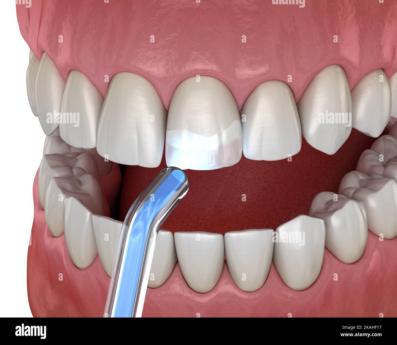 Tooth restoration with filling and polymerization lamp. Medically ...
