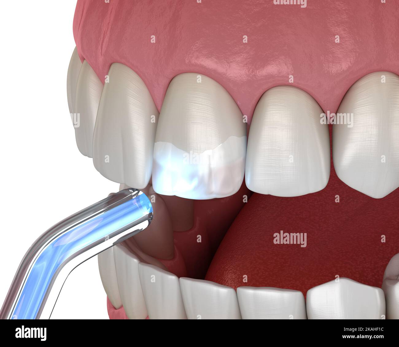 Tooth restoration with filling and polymerization lamp. Medically ...