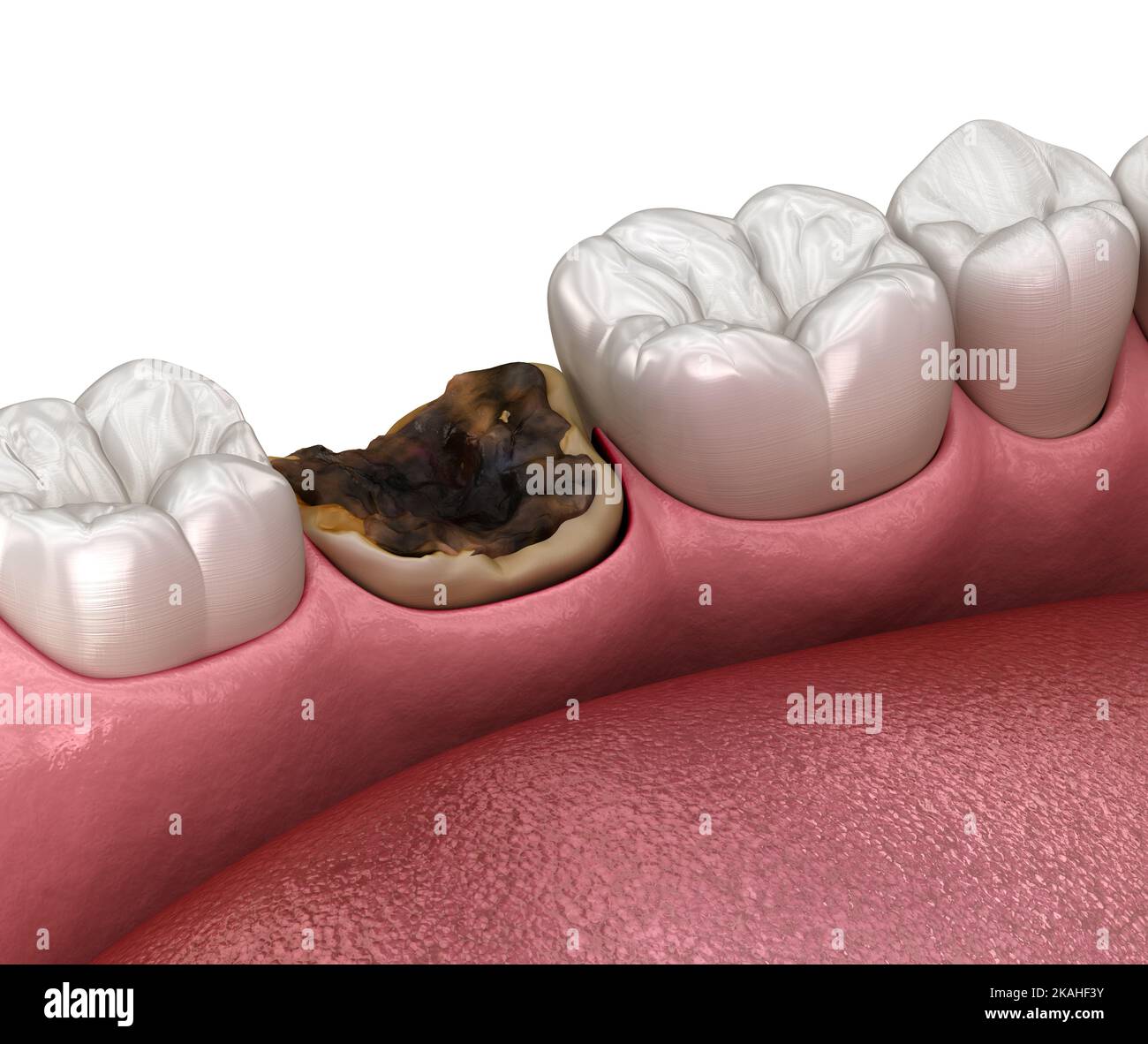 Periodontitis and gum inflammation. Medically accurate dental 3D ...