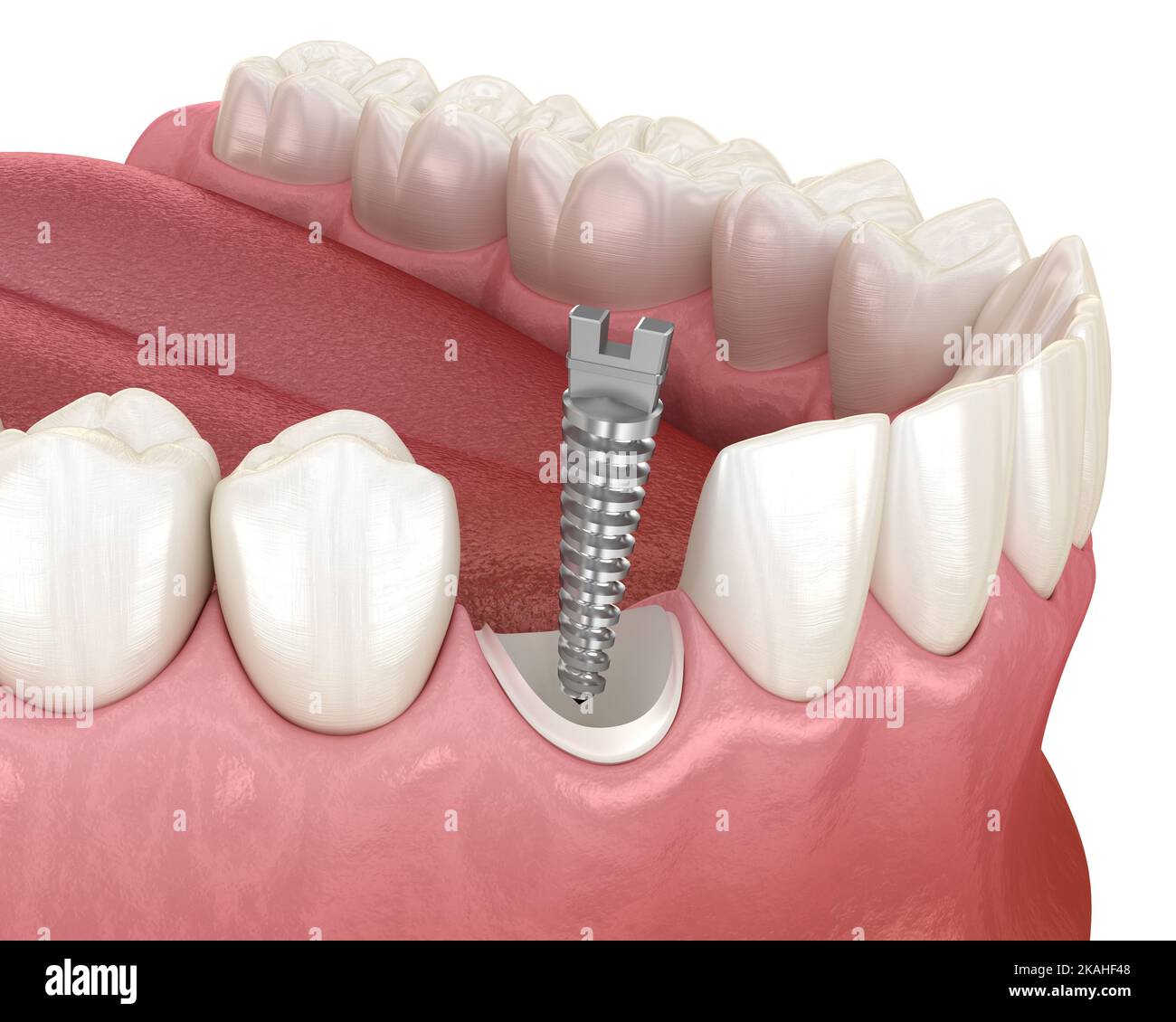 Dental steel post installation in to incisor tooth. Dental endodontic ...