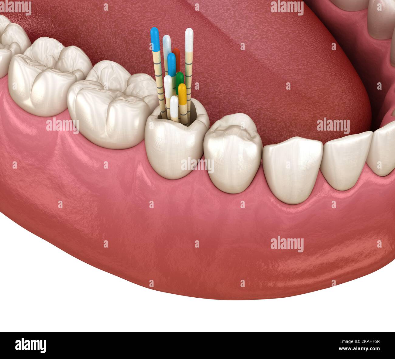 Gutta percha root canal treatment process. Medically accurate tooth 3D ...