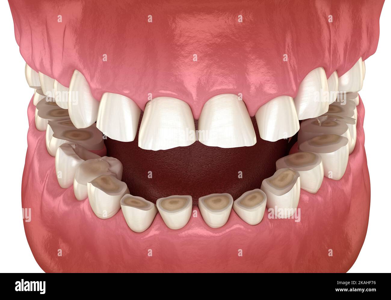 Dental attrition (Bruxism) resulting in loss of tooth tissue. Medically ...