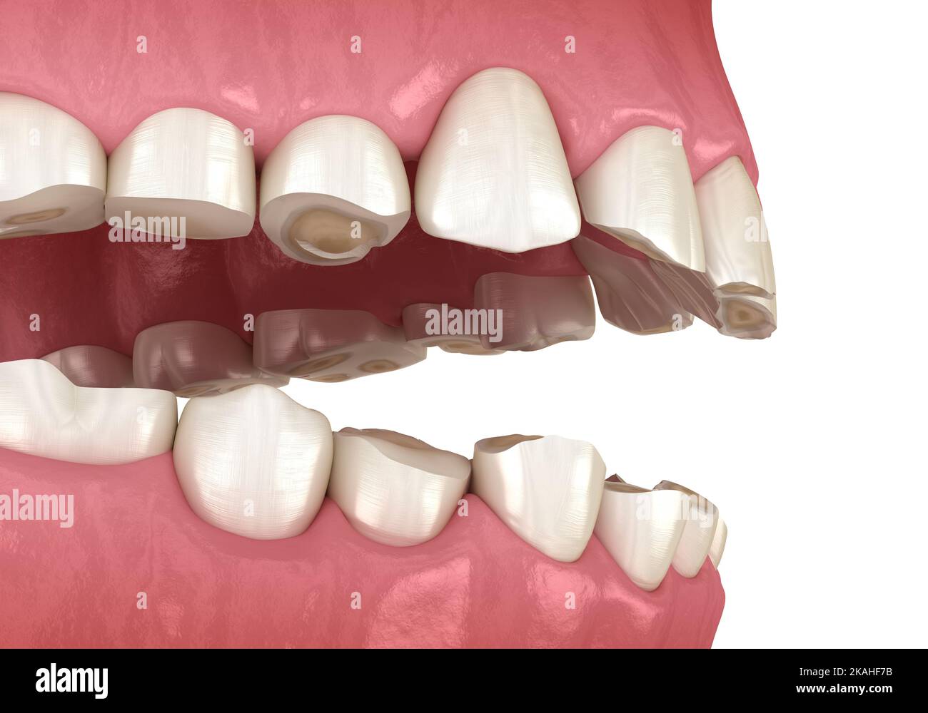 Dental attrition (Bruxism) resulting in loss of tooth tissue. Medically ...