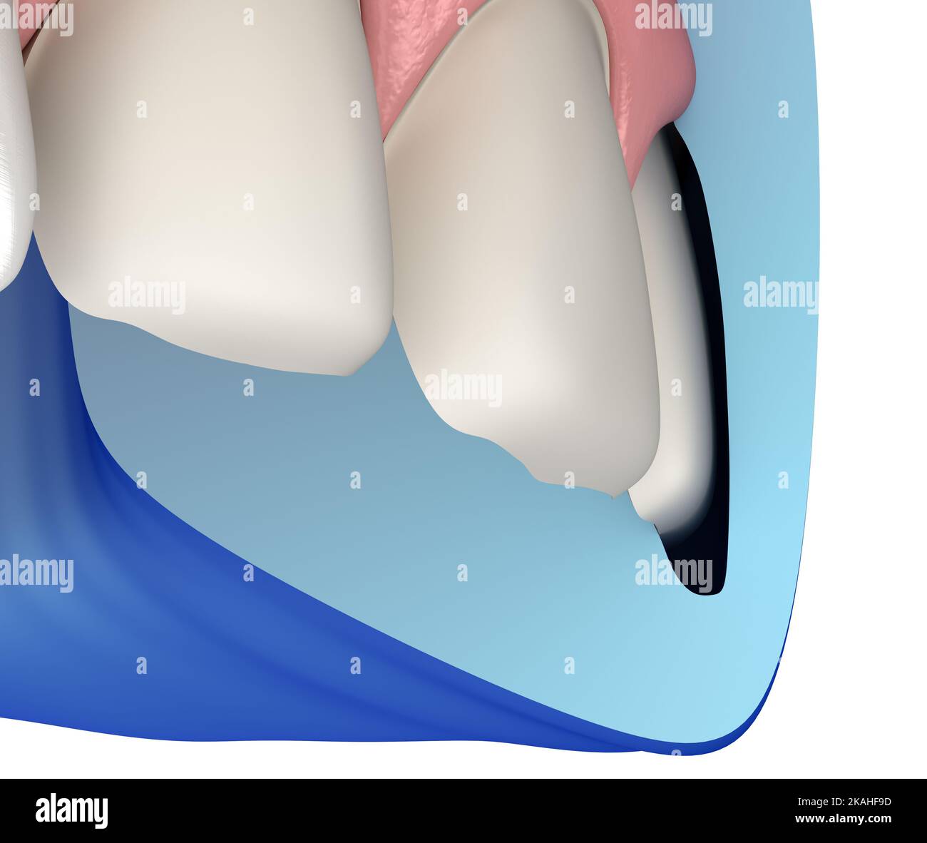 Cross-section of Mock-up dental key and prepareted incisor. Medically ...