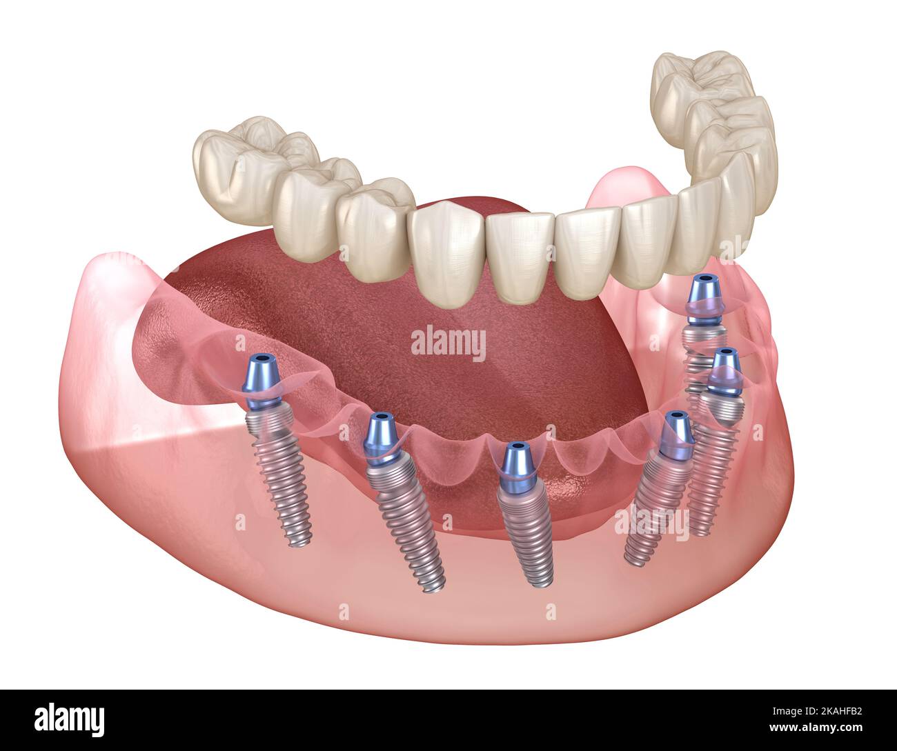 Mandibular prosthesis with gum All on 6 system supported by implants ...