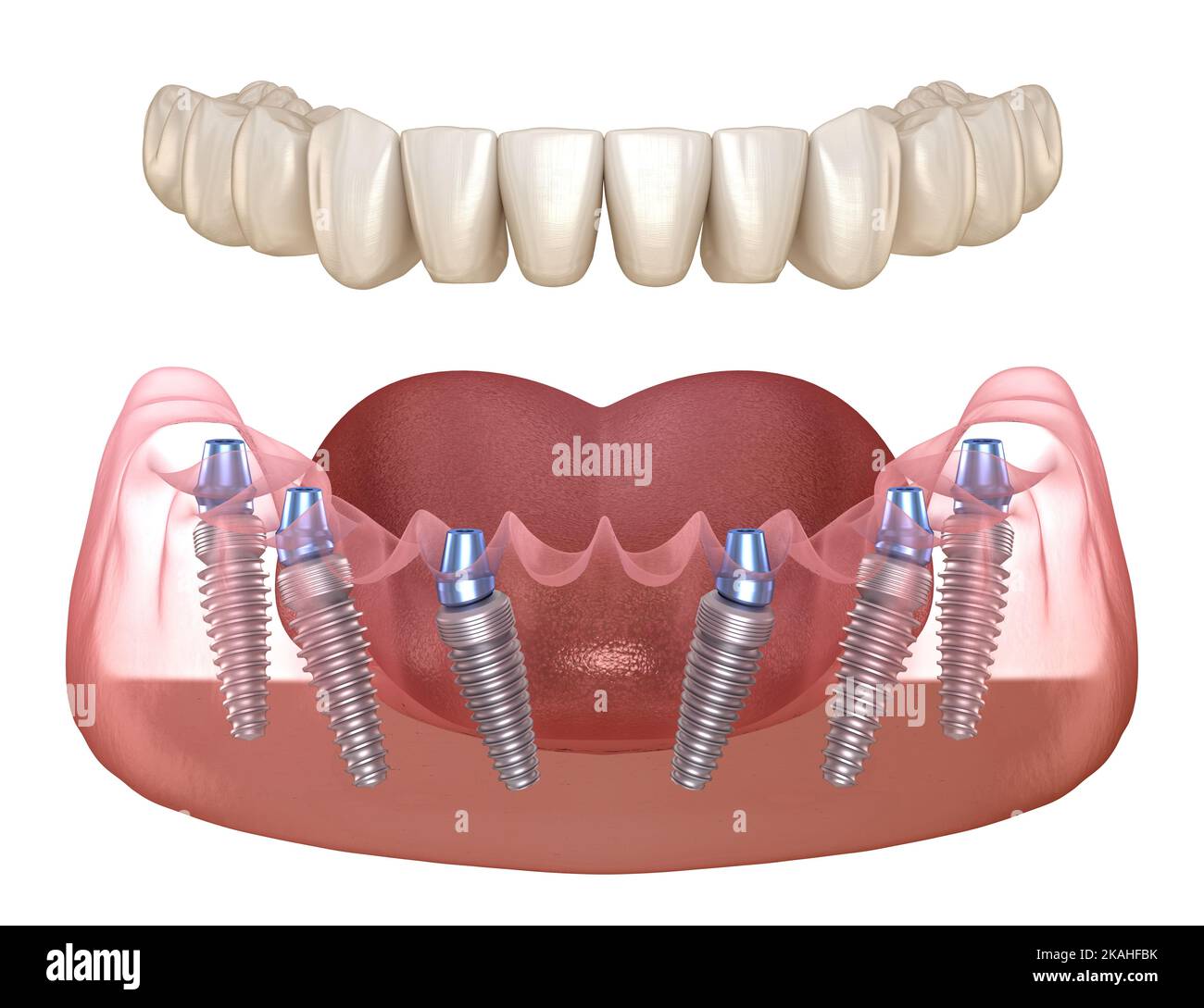 Mandibular prosthesis with gum All on 6 system supported by implants ...