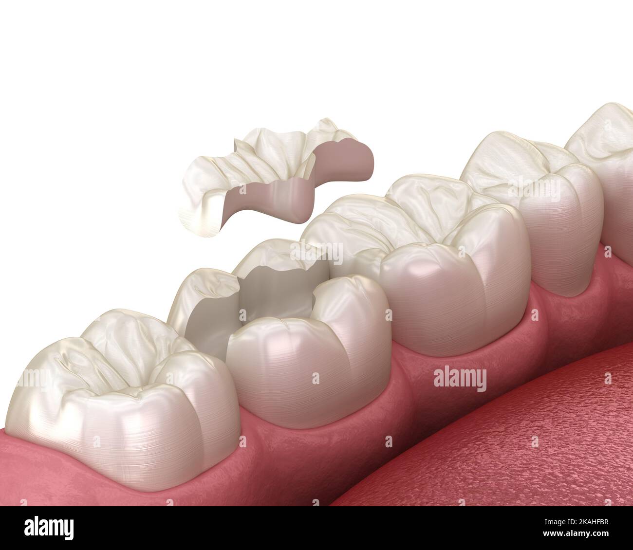 Inlay ceramic crown installation in to the tooth. Medically accurate 3D ...