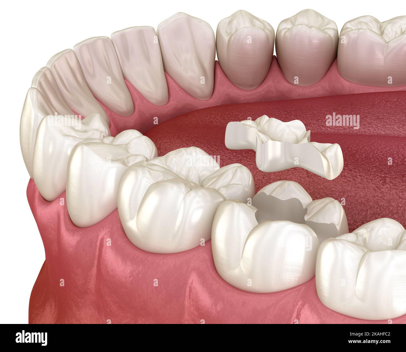 Inlay ceramic crown installation in to the tooth. Medically accurate 3D ...
