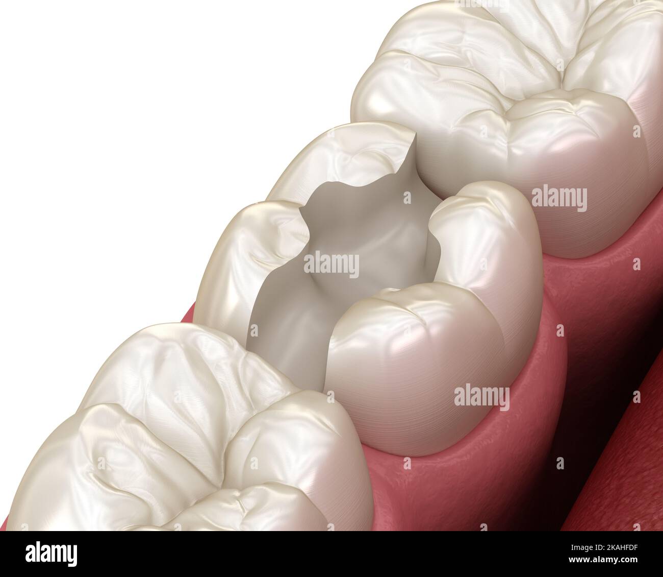 Inlay ceramic crown installation in to the tooth. Medically accurate 3D ...