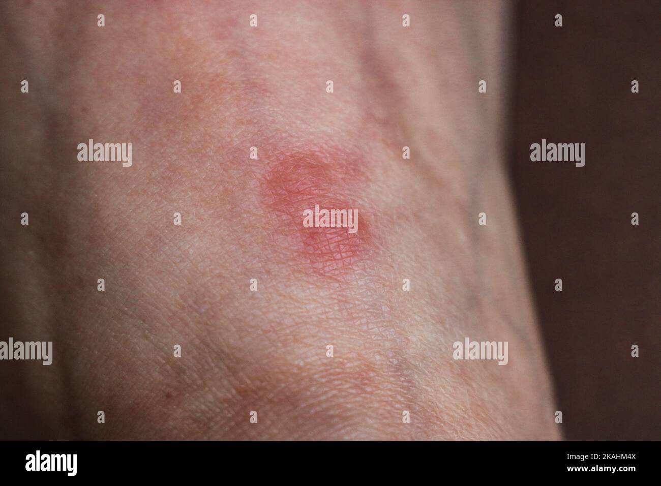 Red inflammation from damage to human skin after an insect bite. An ant ...