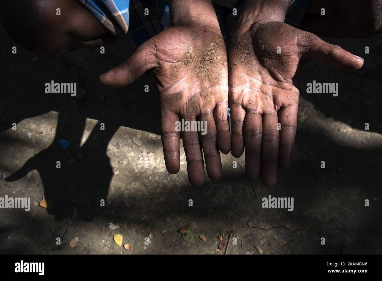 A pair of hardworking hand is highly affected due to arsenic ...