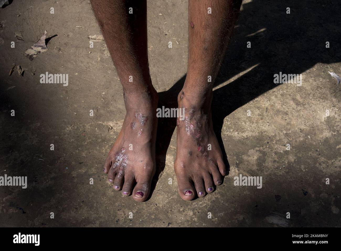 A pair of feet depicts the deadly scars of arsenic poisoning.Gaighata ...