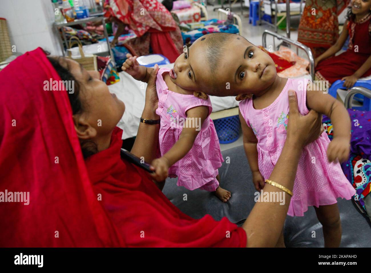 Bangladeshi conjoined baby girls twins Rabia and Rukia admitted in ...