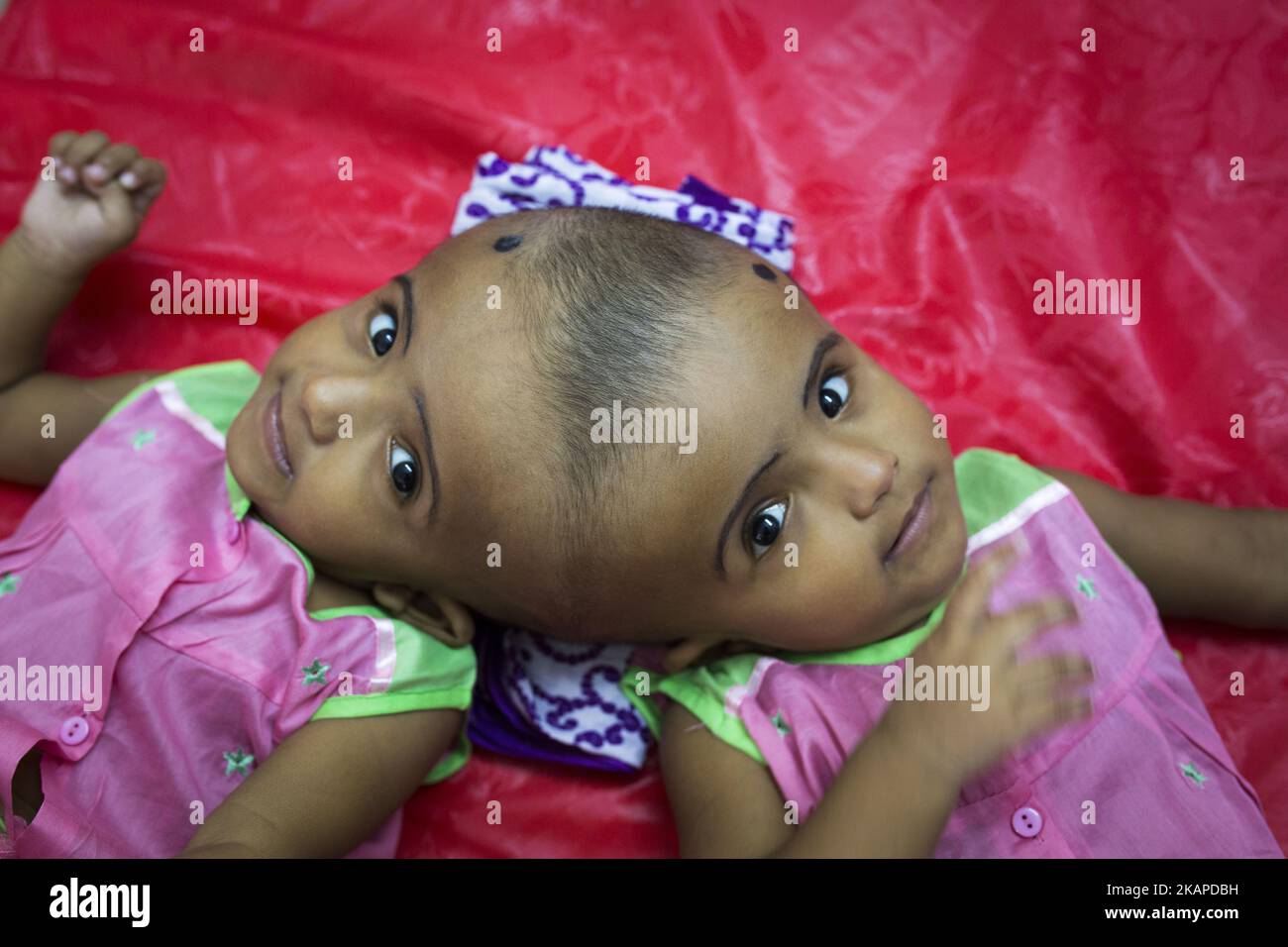 Conjoined twin human hi-res stock photography and images - Alamy