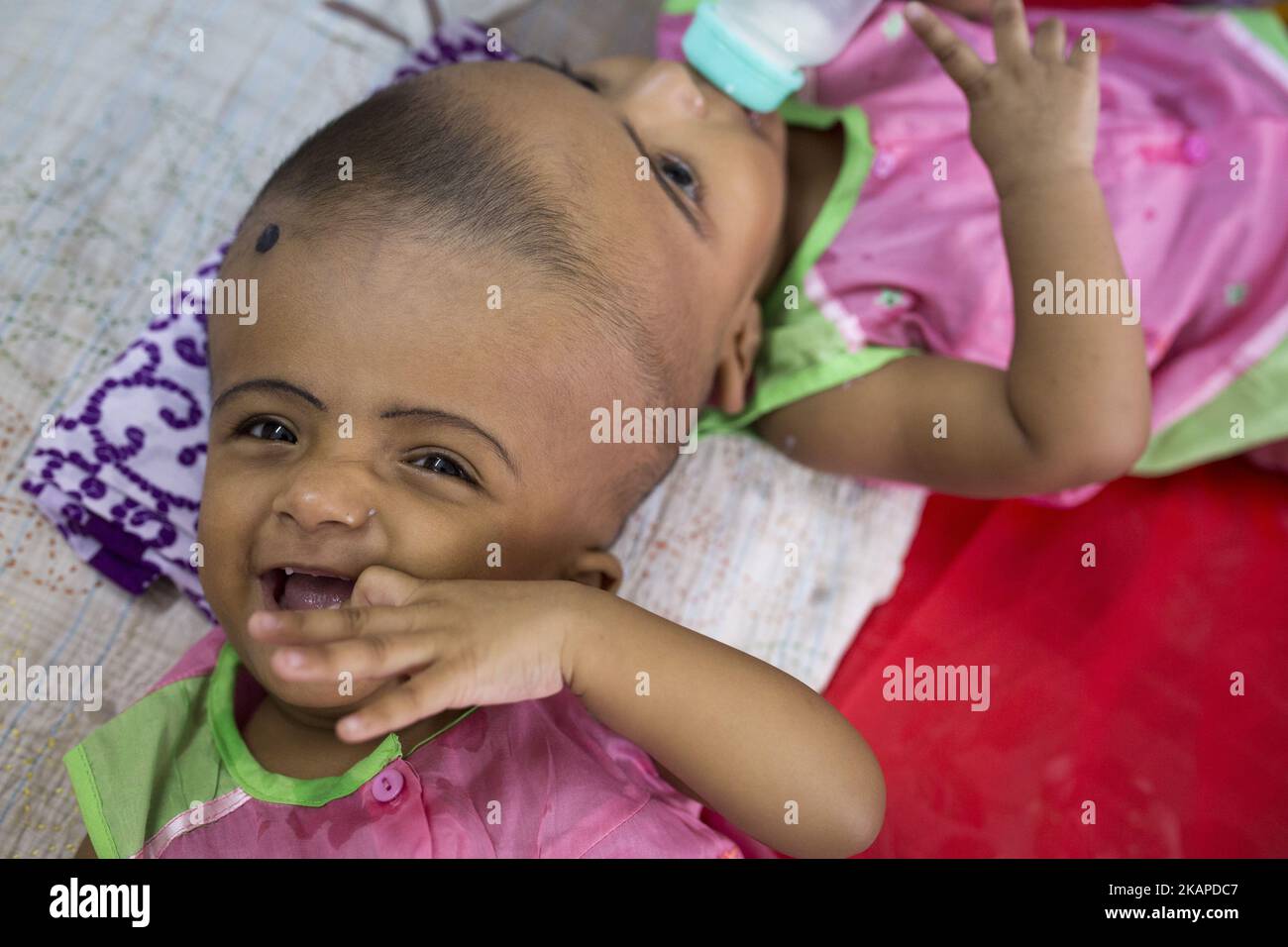 Conjoined twin human hi-res stock photography and images - Alamy