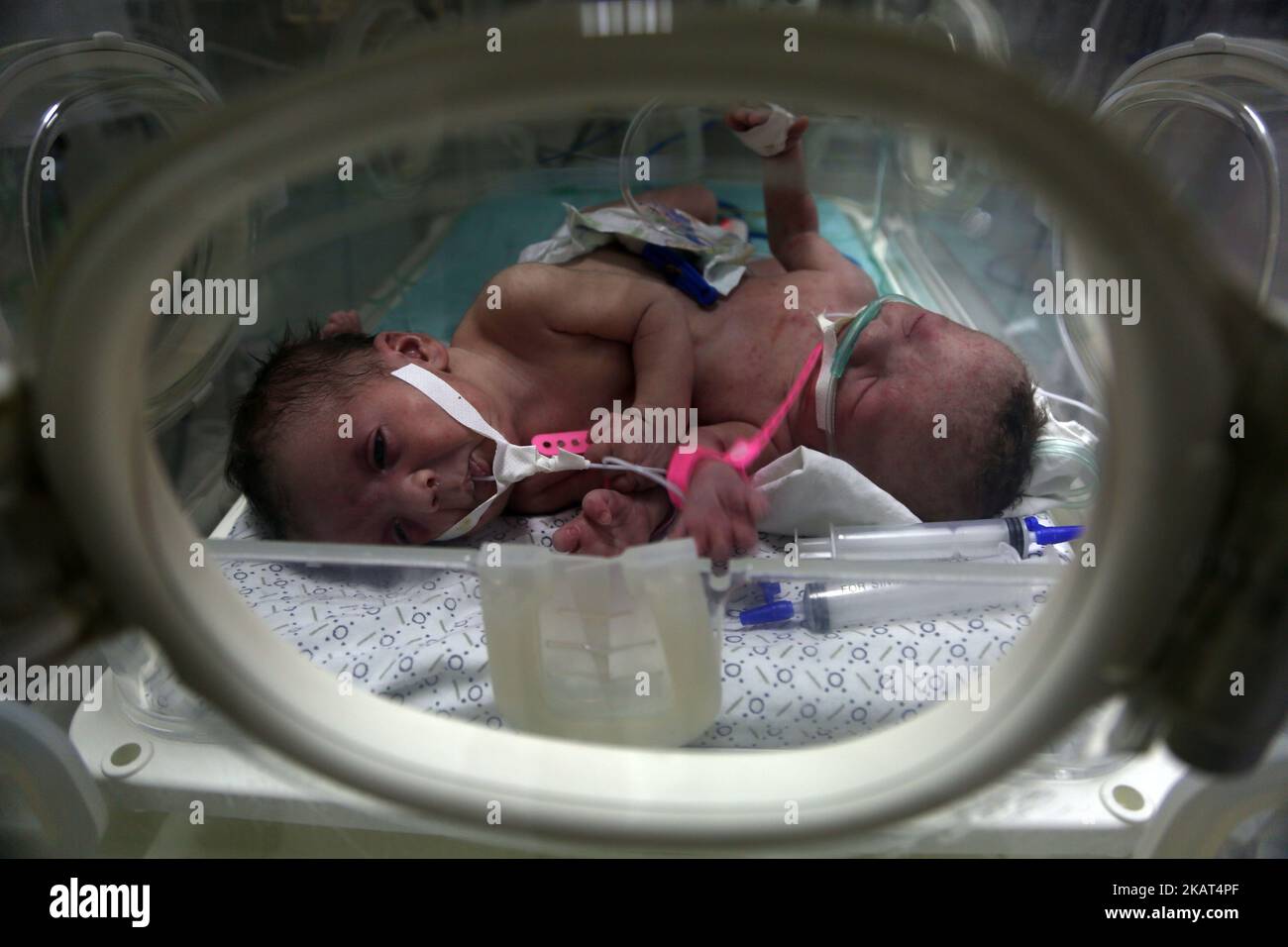 Conjoined twin hi-res stock photography and images - Alamy