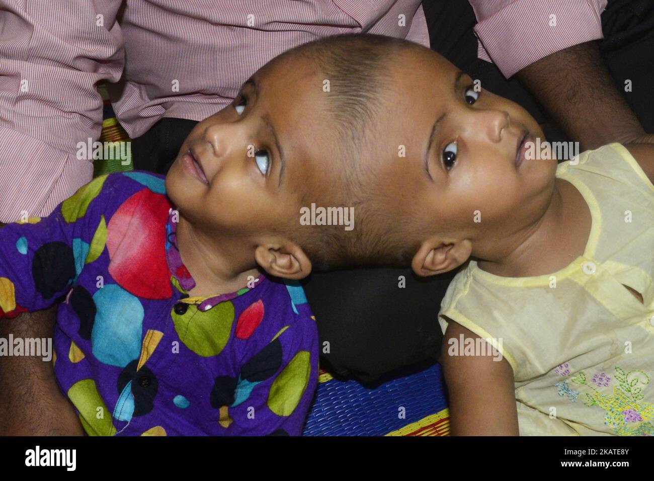 Conjoined twin separation hi-res stock photography and images - Alamy