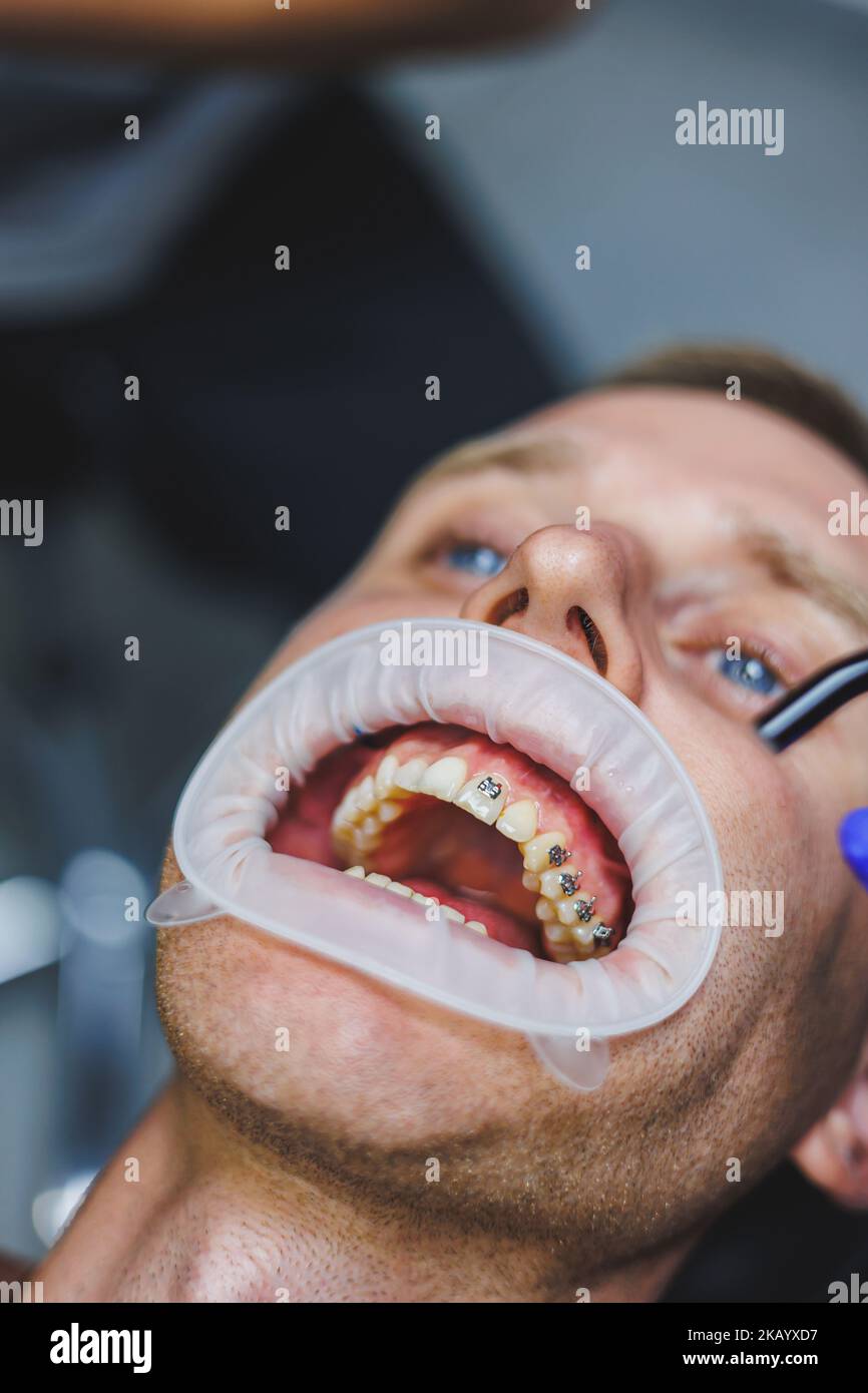 Dental treatment of teeth. A young man at a dentist's appointment. The ...