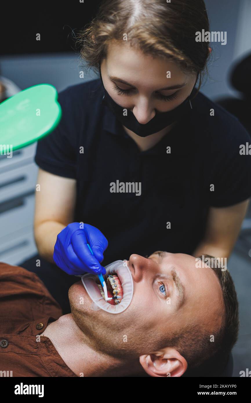 Orthodontic treatment of teeth. The doctor installs metal braces on the ...