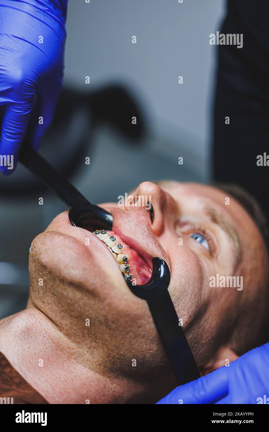 Dental treatment of teeth. A young man at a dentist's appointment. The ...