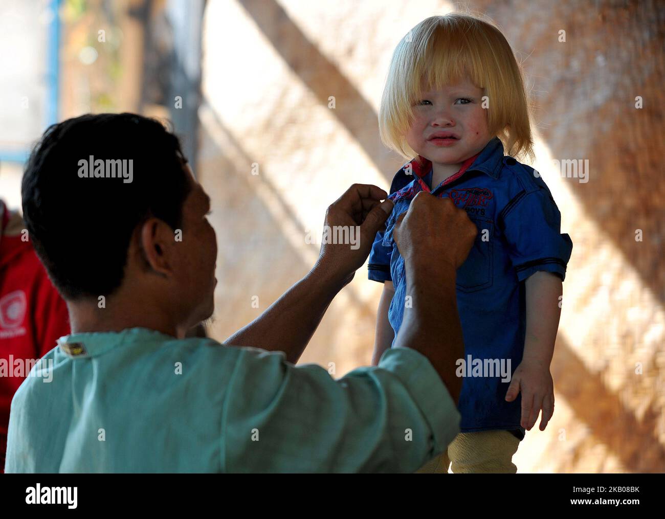 Jajang Gunuwan 3 years old one of the children of Albino descent with ...