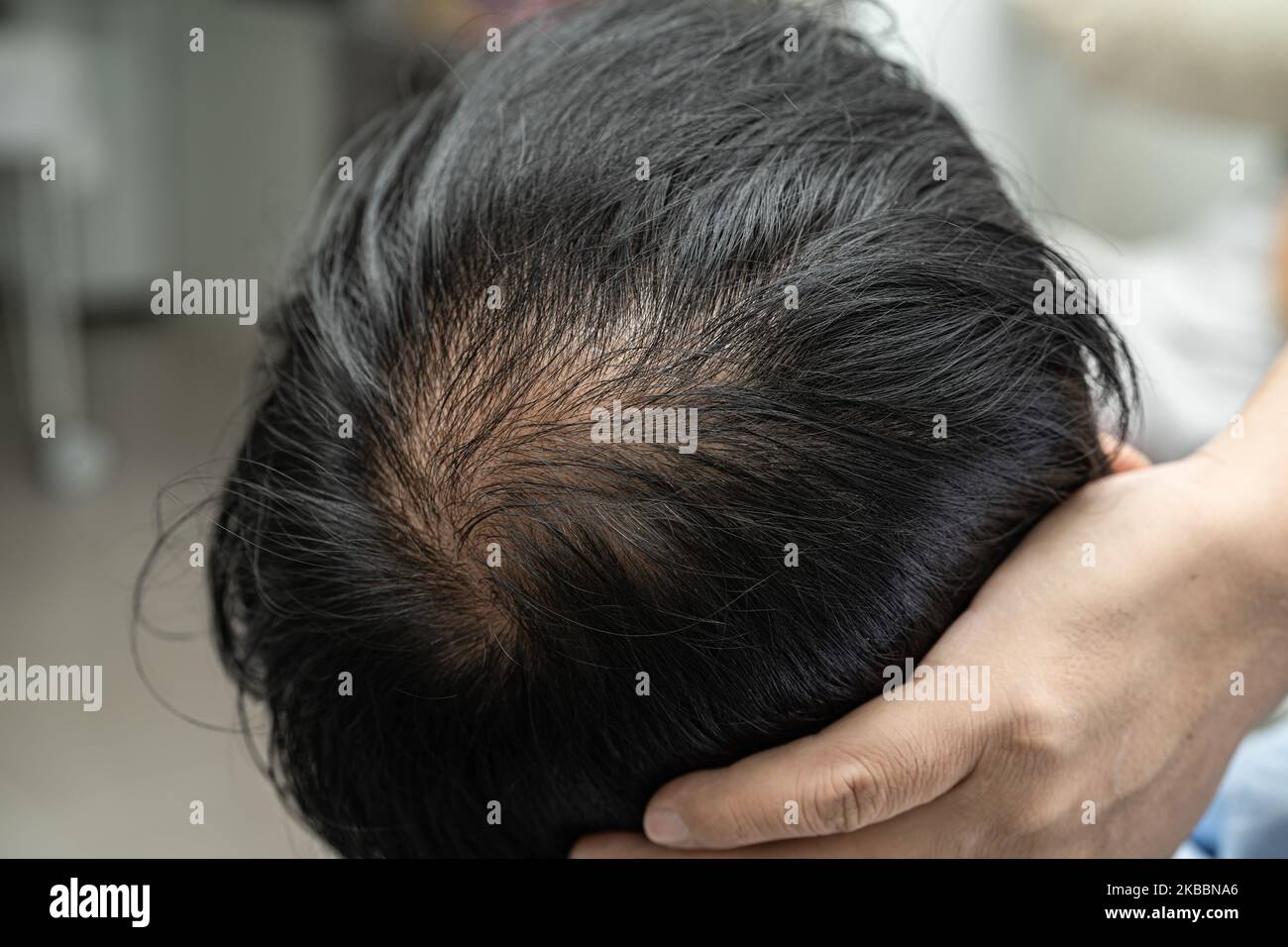 Bald in the middle head and begin no loss hair glabrous of mature Asian ...