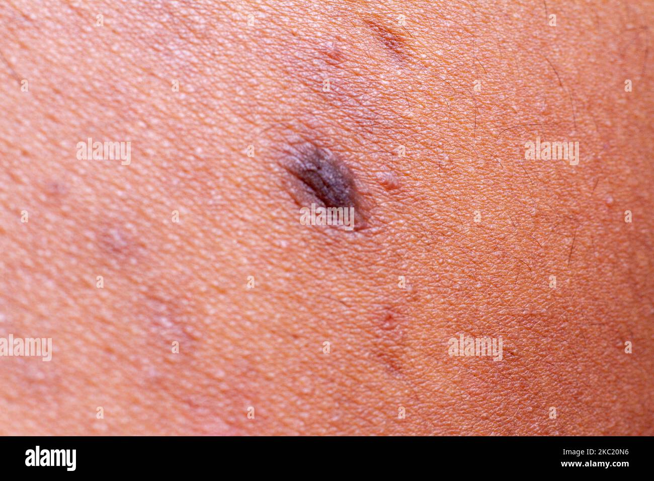 human skin texture. wart and pimples on skin micro photo. close up ...