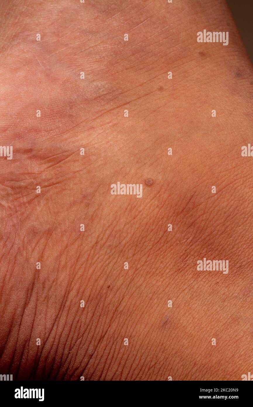 human skin texture. Flat wart on skin micro photo. close up photo Stock ...