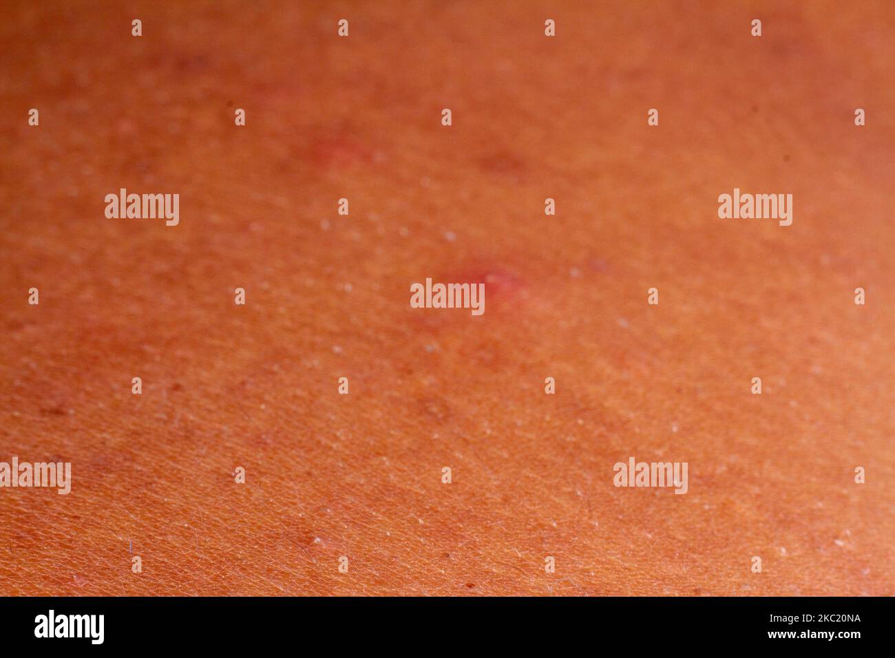 human skin texture. pimples on skin micro photo. close up photo Stock ...