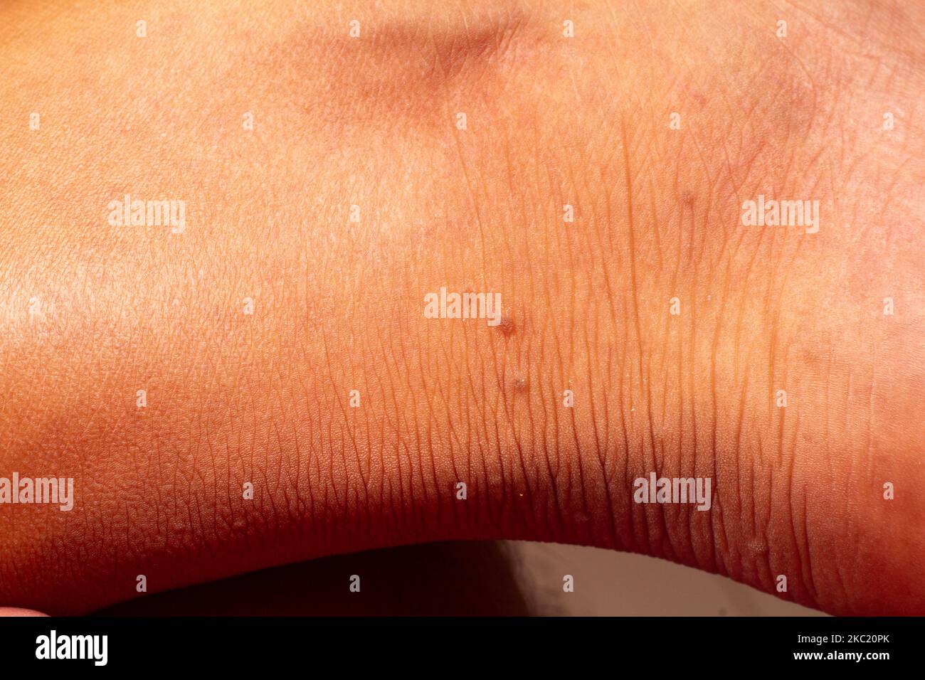 human skin texture. Flat wart on skin micro photo. close up photo Stock ...