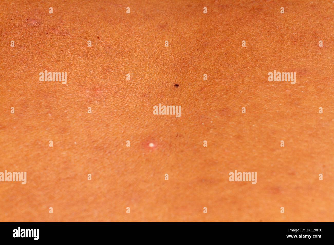 human skin texture. pimples on skin micro photo. close up photo Stock ...