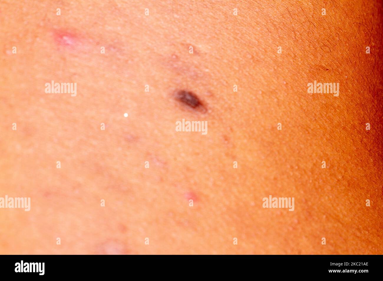 human skin texture. wart and pimples on skin micro photo. close up ...