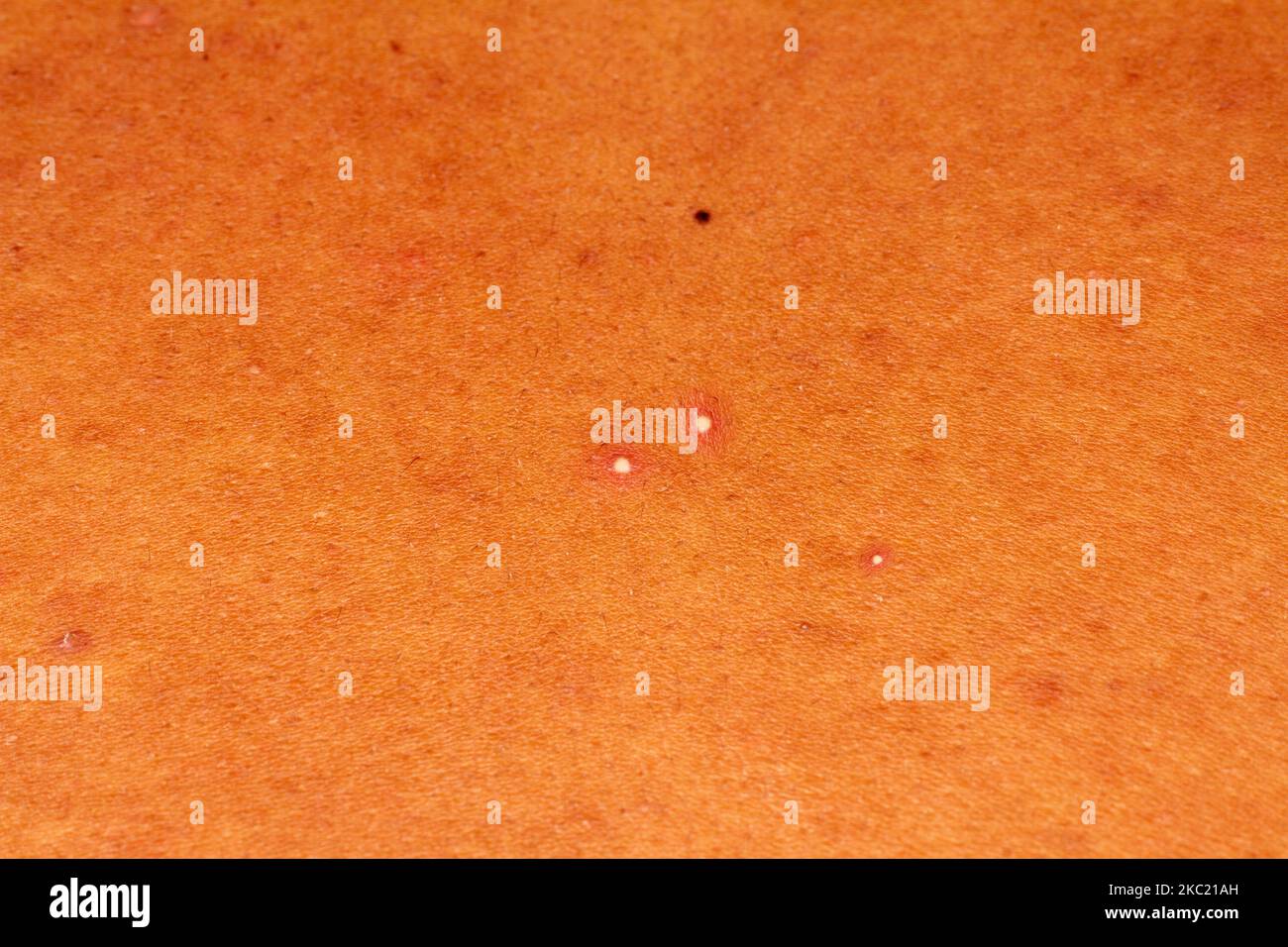 human skin texture. pimples on skin micro photo. close up photo Stock ...