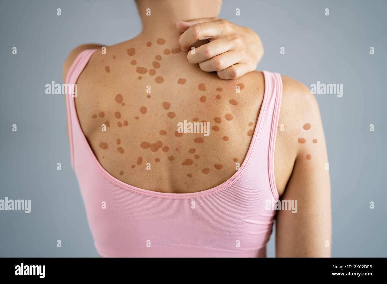 Skin Rash And Itchy Back Acne. Dry Eczema Allergy Stock Photo - Alamy