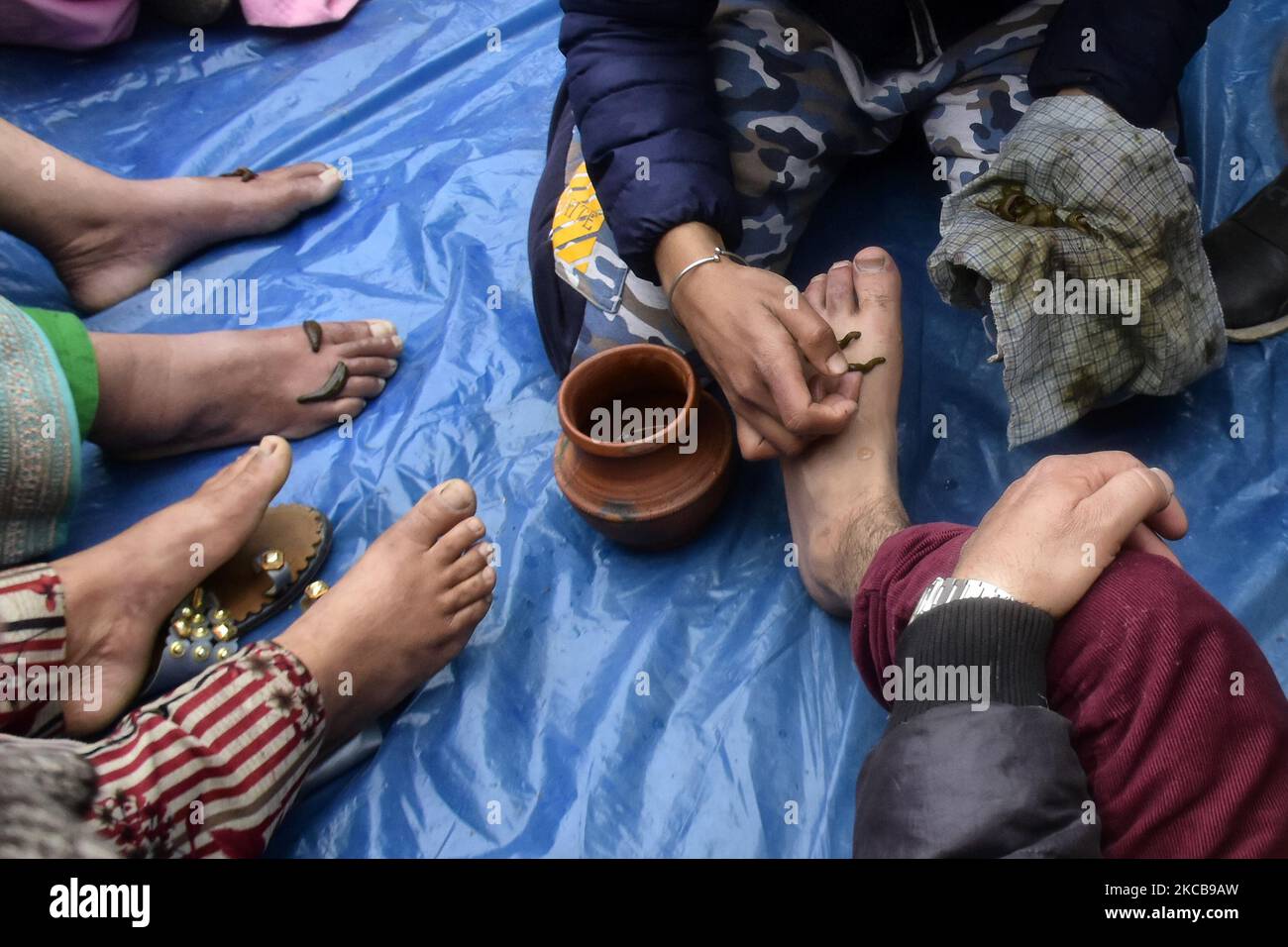 Kashmiri people take leech therapy on the eve of Nauroz (Persian New ...