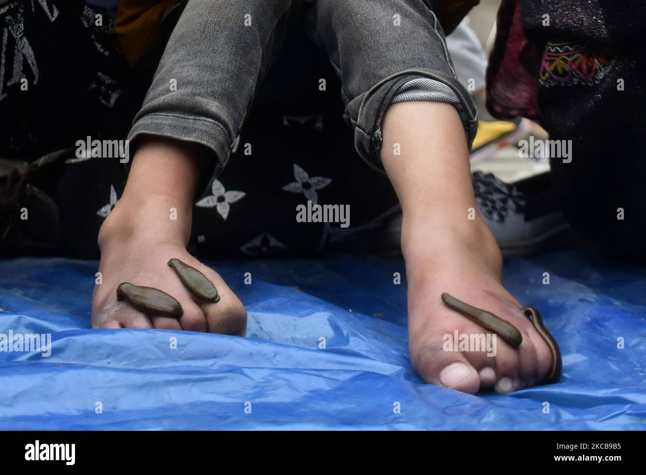 Kashmiri people take leech therapy on the eve of Nauroz (Persian New ...