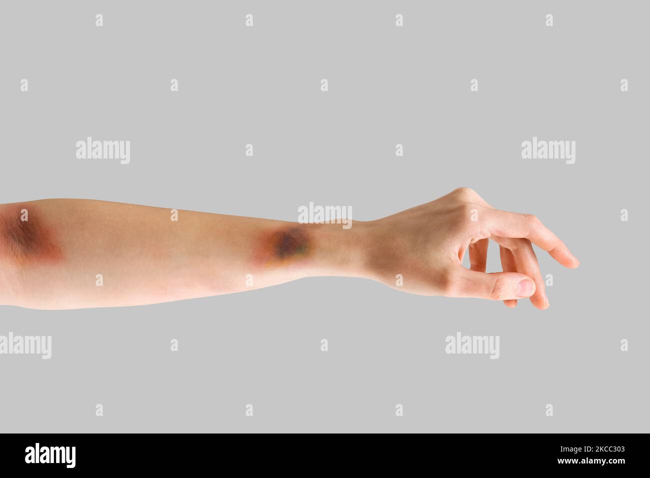 Female bruised hi-res stock photography and images - Alamy