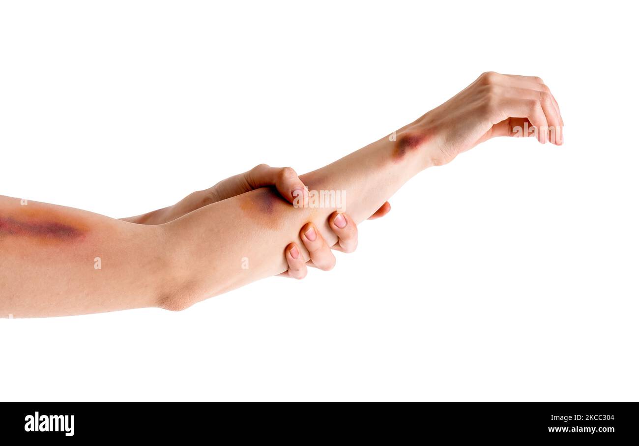 Bruised hands hi-res stock photography and images - Alamy