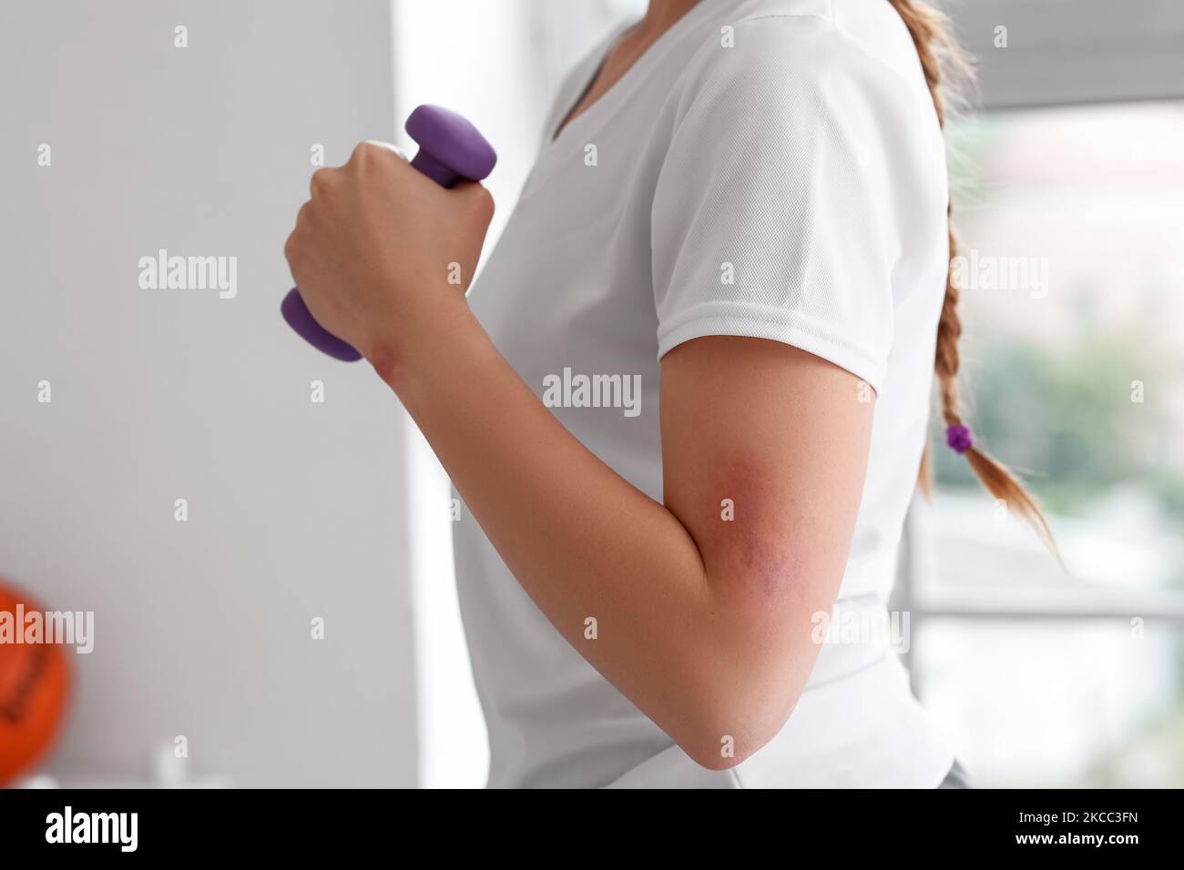 Sporty young woman with bruised arm and dumbbell in gym, closeup Stock ...