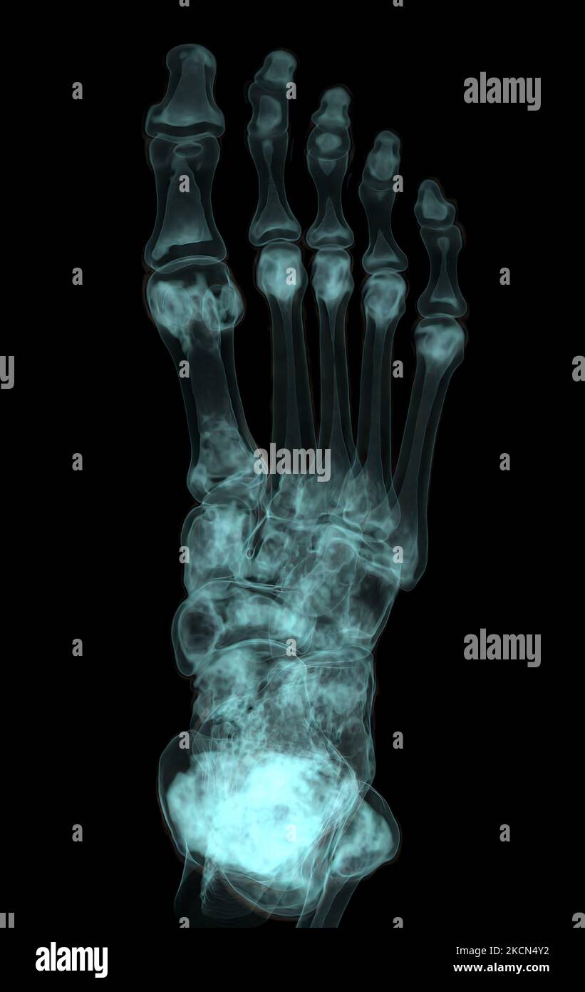 3D rendering of the foot bones for diagnosis bone fracture and ...