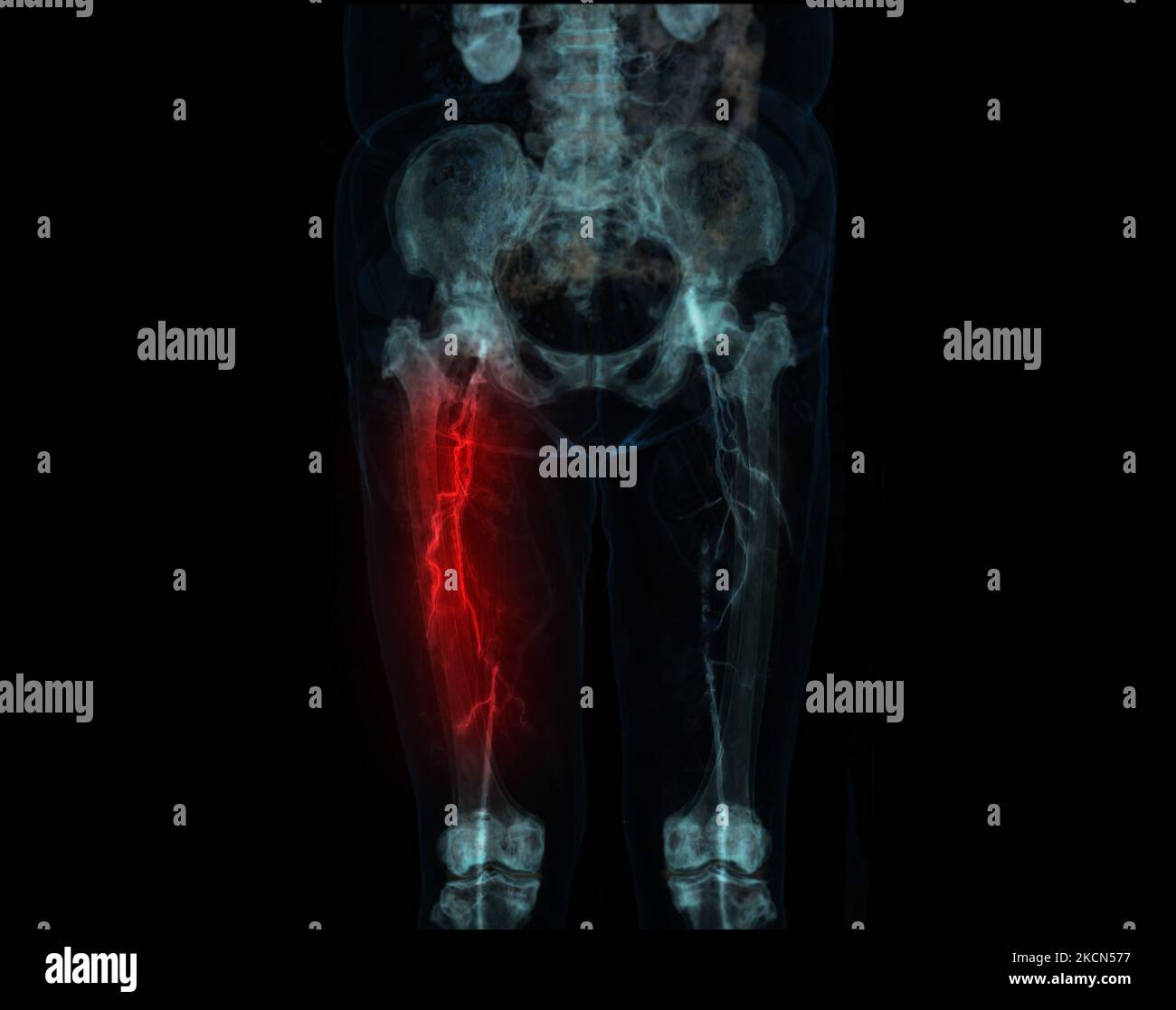 CT scan of lower extremity ,3D illustration of Femur bone , knee joint ...