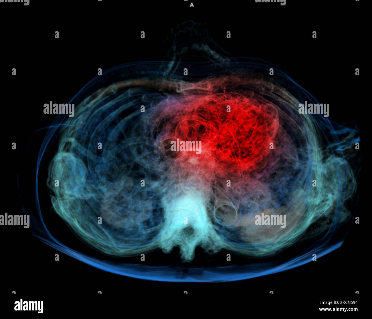 Human heart attack pain as an anatomy medical disease concept with a ...