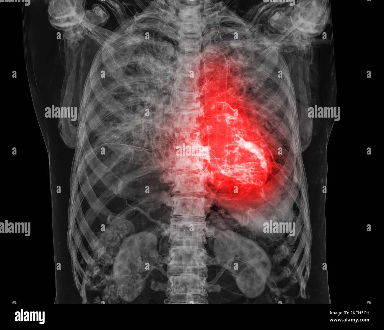 Human heart attack pain as an anatomy medical disease concept with a ...