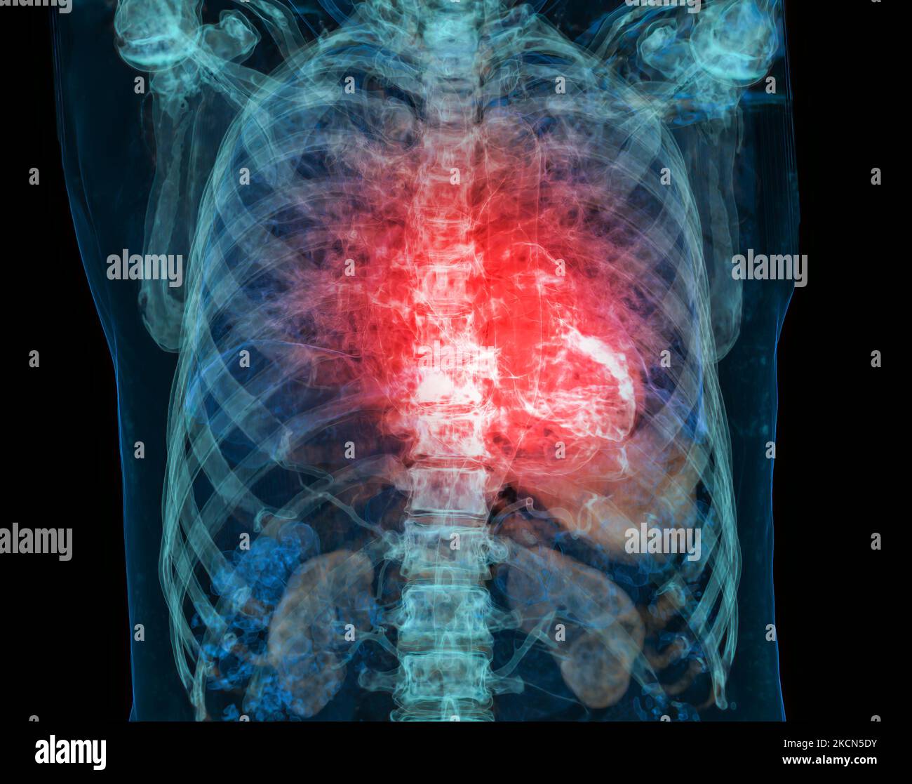 Human heart attack pain as an anatomy medical disease concept with a ...