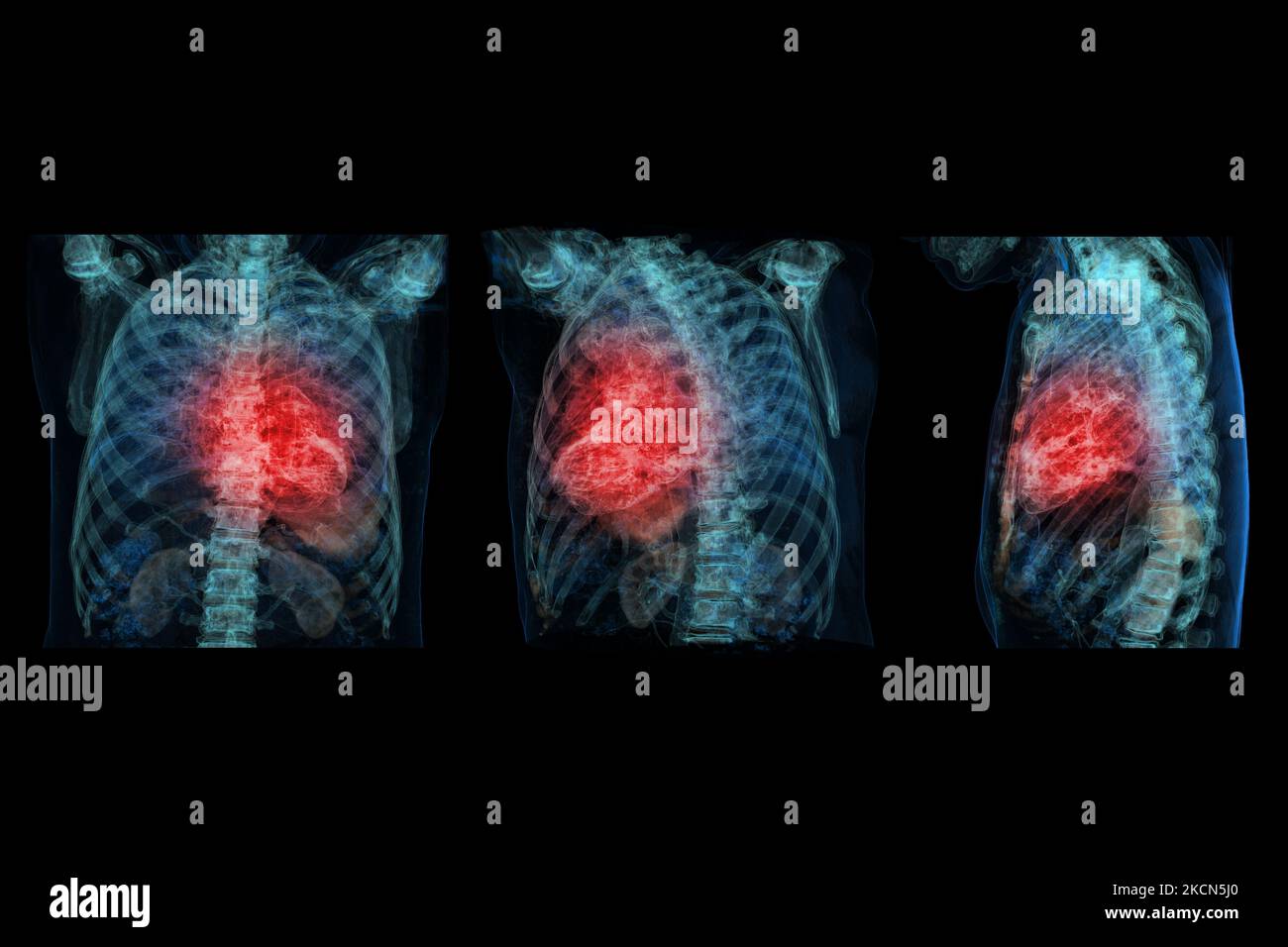 Human heart attack pain as an anatomy medical disease concept with a ...