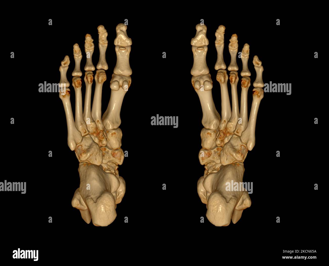 3D rendering of the foot bones for diagnosis bone fracture and ...