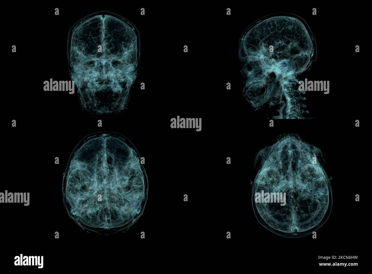 Collection of Human Skull, Brain by CT Scan. X-ray Visualization Inside ... Collection of Human Skull, Brain by CT Scan. X-ray Visualization Inside ...