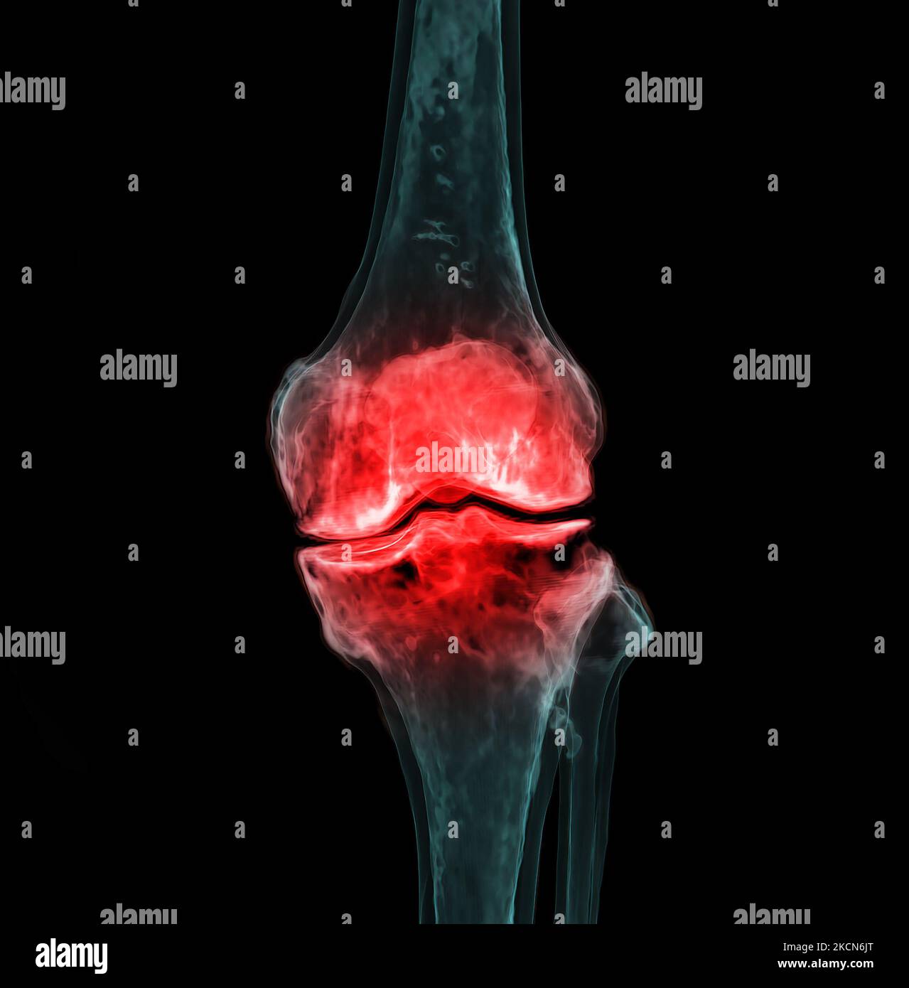 3d renderering of the knee joint isolated on black background Showing ...